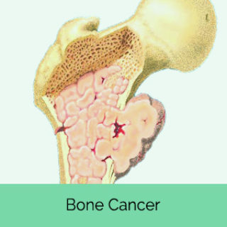 Bone cancer Types, Causes, Symptoms and treatment | Science online