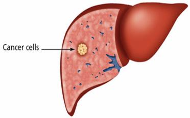 Liver Cancer (Hepatocellular Carcinoma) types, causes, symptoms and ...