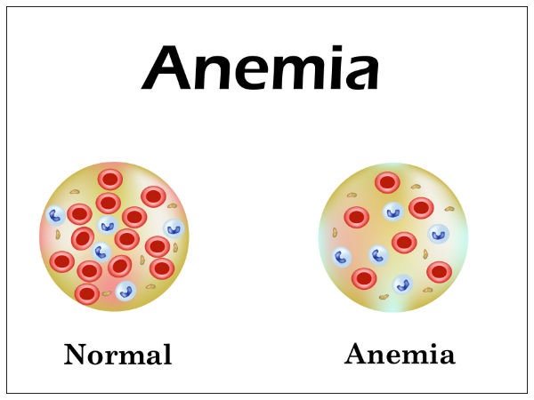Anemias causes, symptoms, features, diagnosis and Types of Polycythemia ...