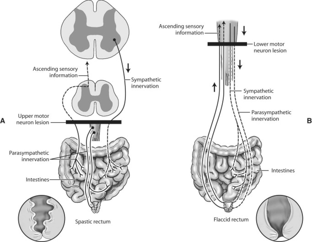 Nerve Palsy Upper And Lower Motor Neuron Lesions - Infoupdate.org